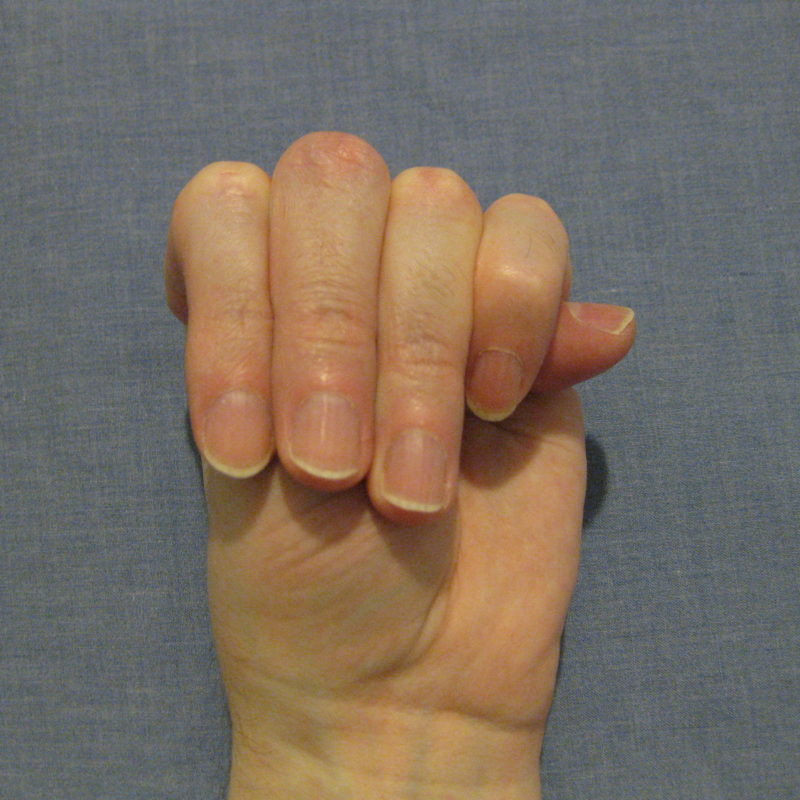 The Gallery page showing hypermobile joints.